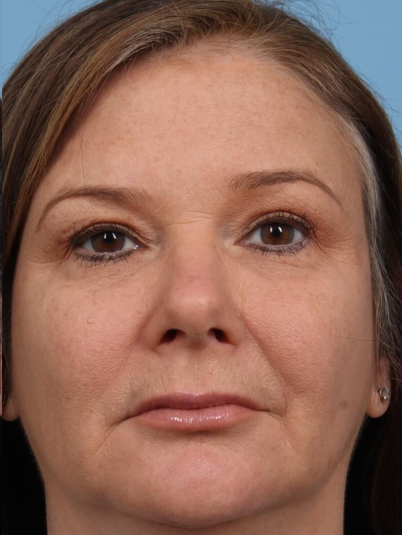 Endoscopic Browlift with Upper Eyelid Surgery | Case 89945