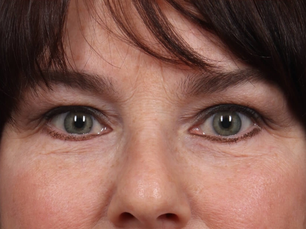 Upper and Lower Eyelid Surgery | Case 90830