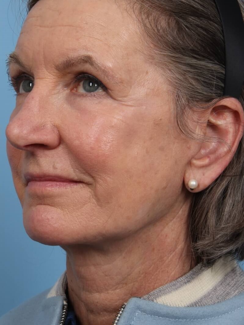 Facelift, Upper and Lower Eyelid Surgery with CO2 Laser to LL | Case 90831
