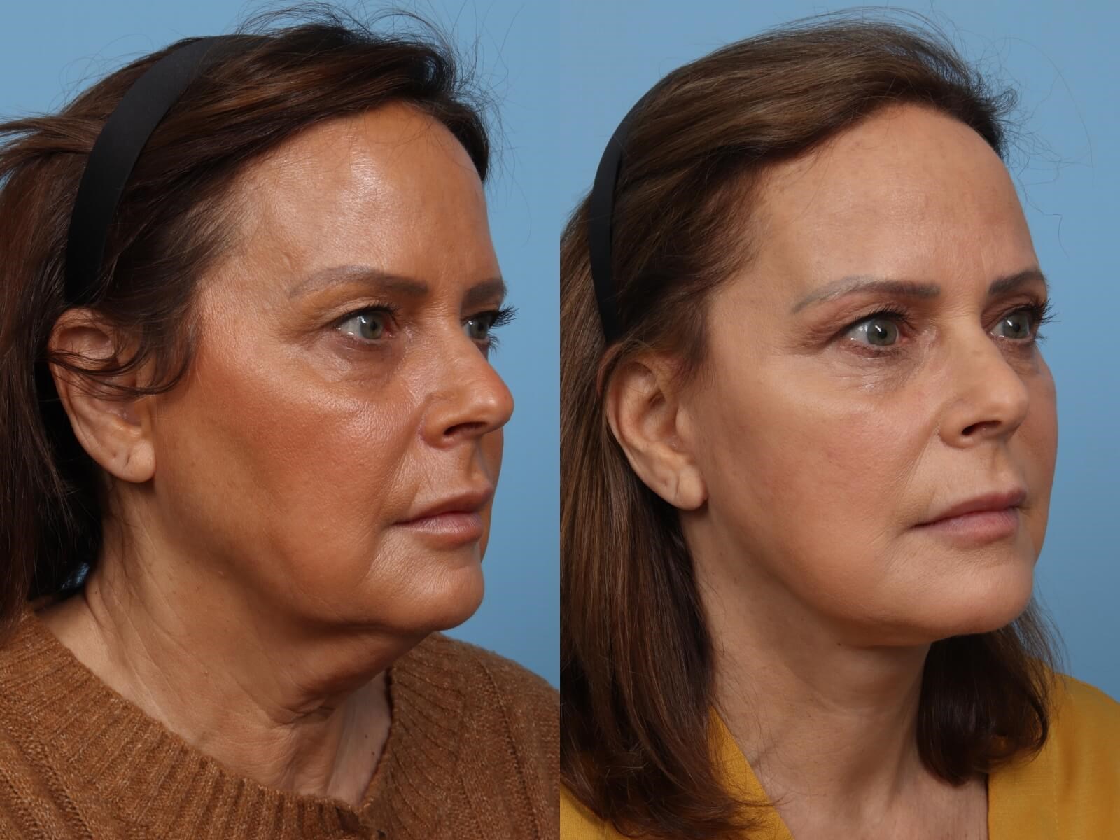 Deep Plane Facelift