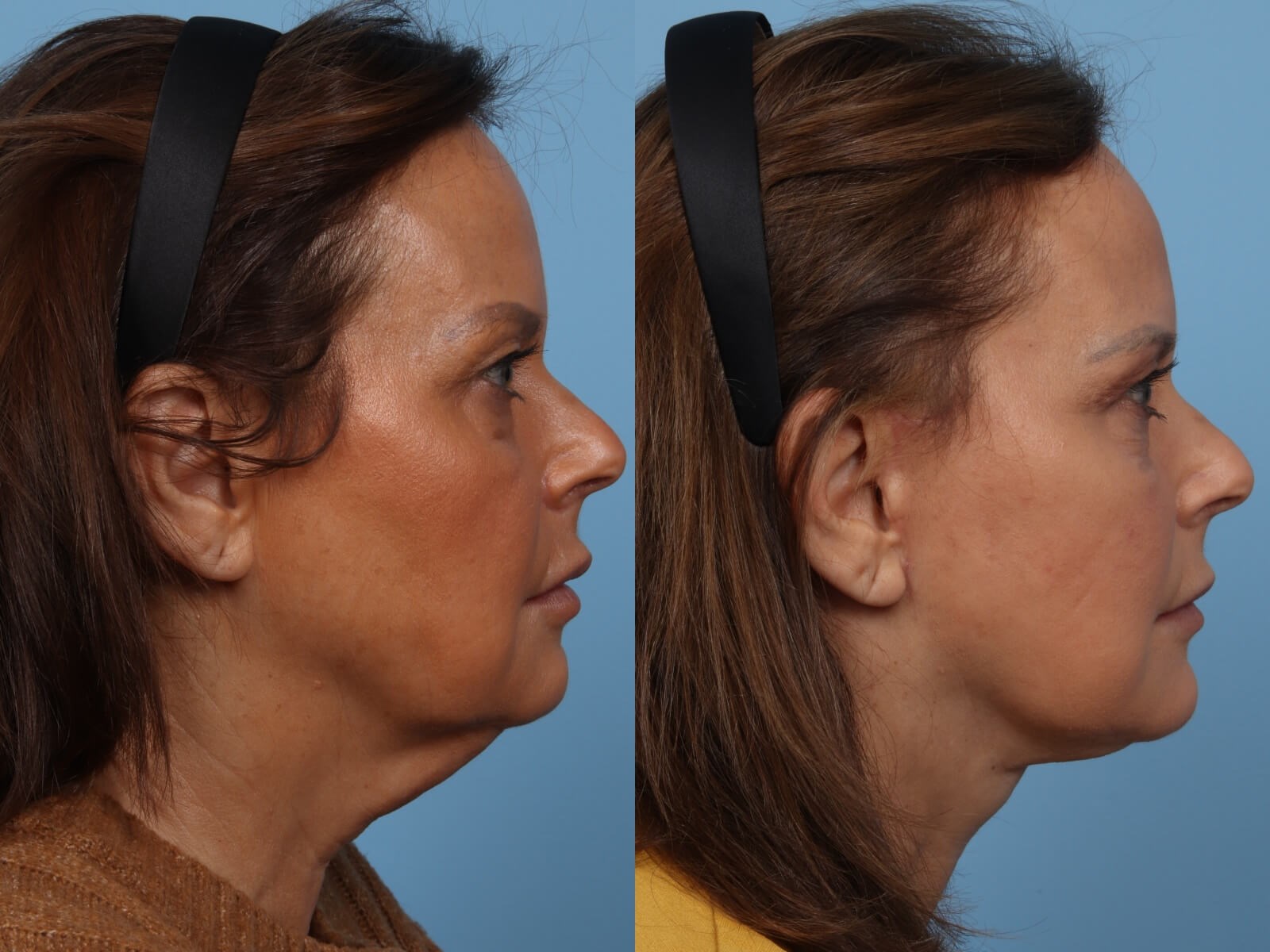 Deep Plane Facelift