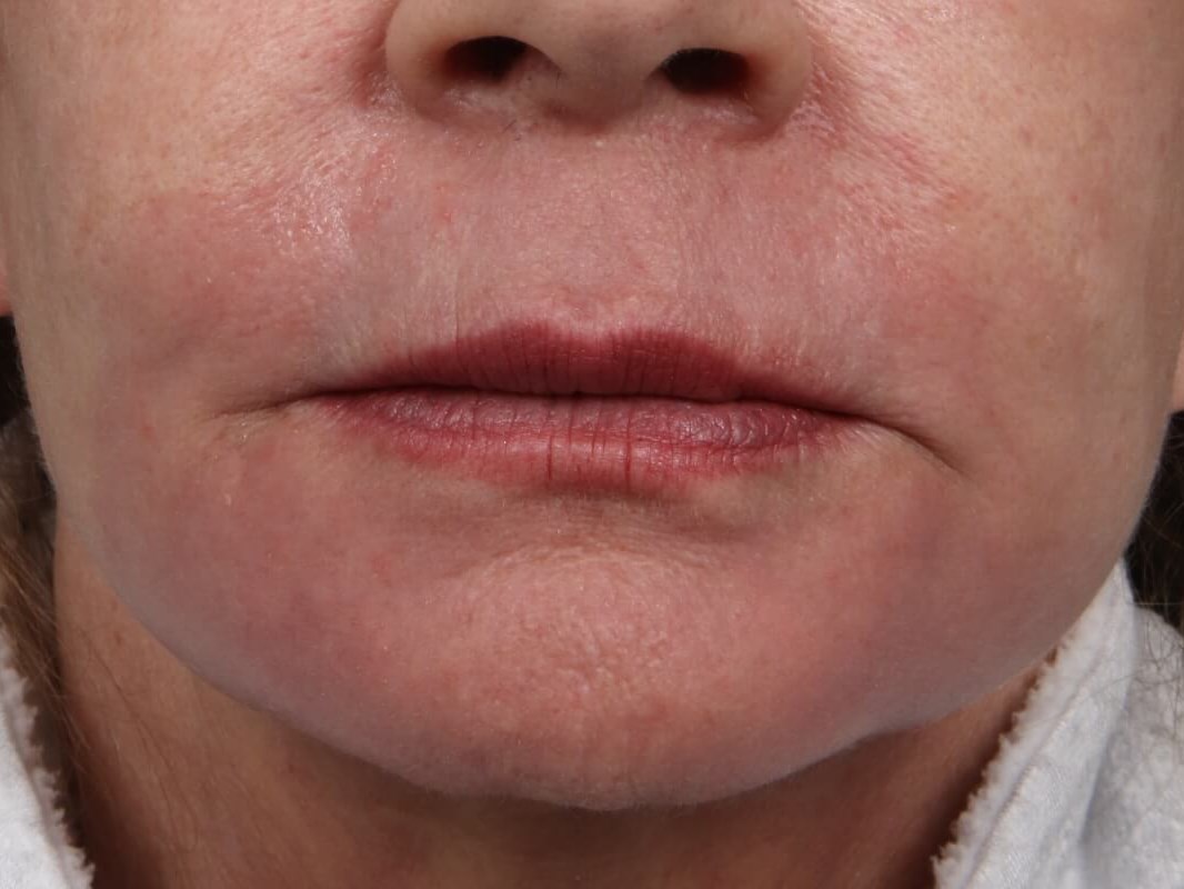 Hetter Peel | Case 95877