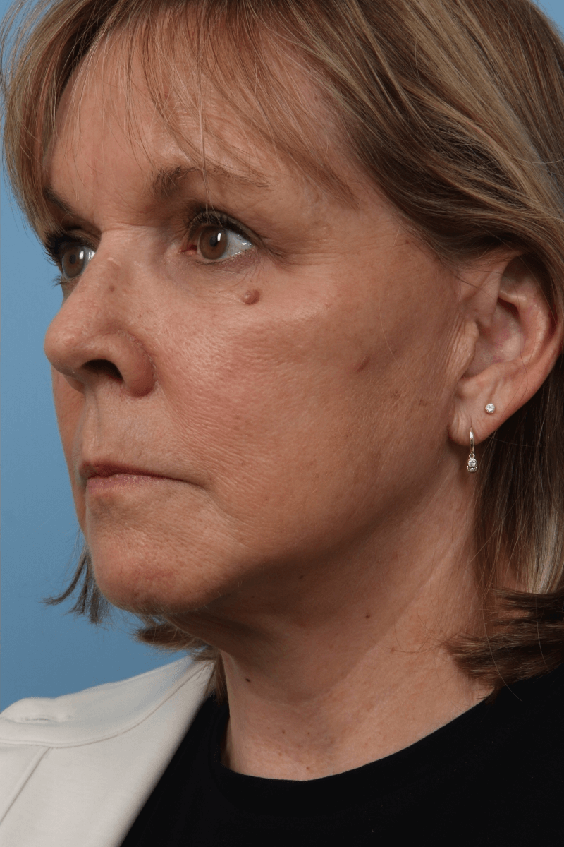 preservation extended deep plane facelift with Upper Eyelid ...