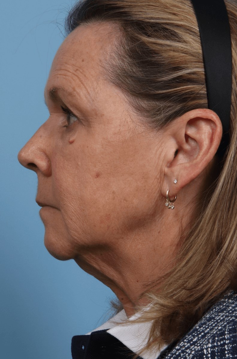 preservation extended deep plane facelift with Upper Eyelid ...