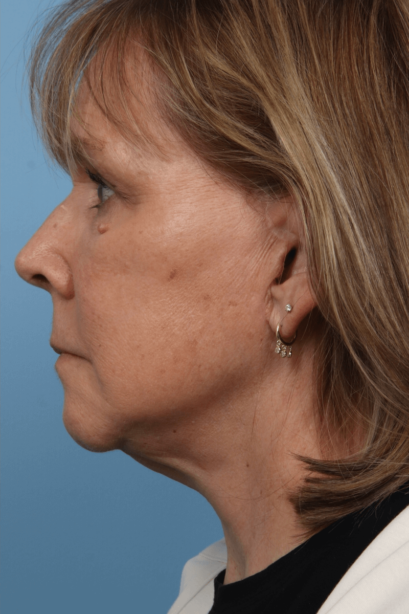 preservation extended deep plane facelift with Upper Eyelid ...