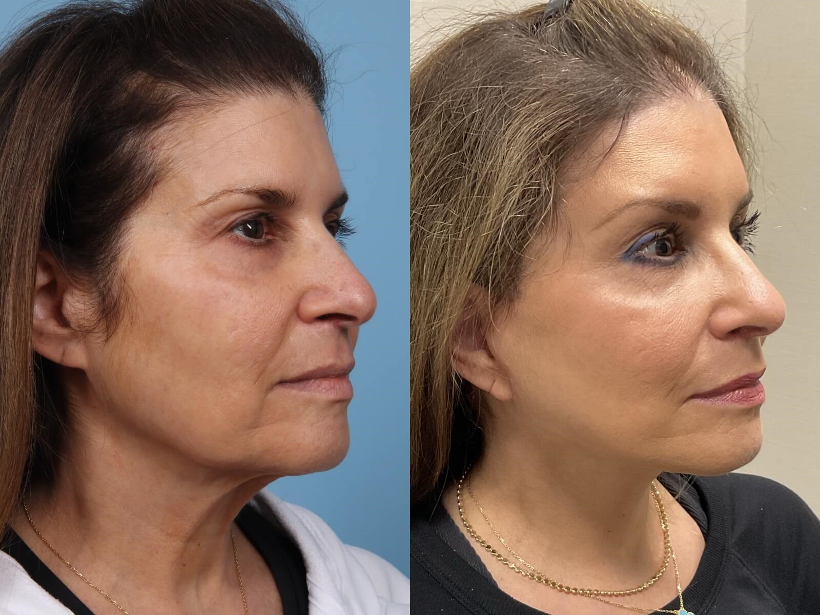 Facelift, Temporal Browlift, Bilateral Upper Lid Blepharoplasty | Case ...